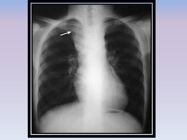 Signs in Chest Xray | PPTX | Lung and Respiratory Health | Diseases and ...