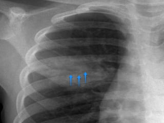 Air Bronchograms On Cxr