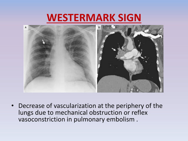 Signs in Chest Xray