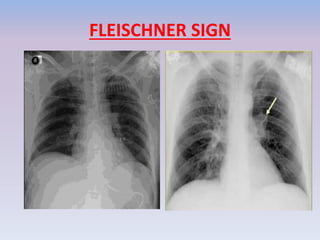 Fleischner Sign