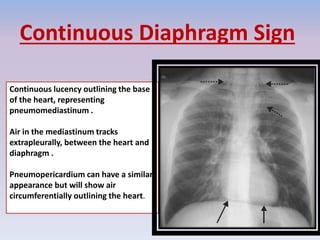 Continuous Diaphragm Sign