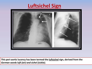 Signs in Chest Xray | PPT