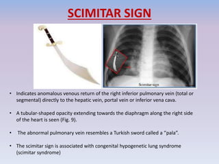 Signs in Chest Xray | PPT