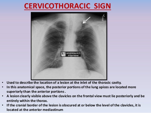 Signs in Chest Xray