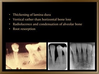 Archana- occlusion in perio.pptx