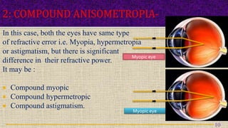 ANISOMETROPIA | PPTX