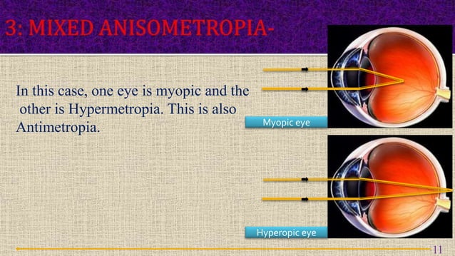 ANISOMETROPIA | PPTX | Eye and Vision Conditions | Diseases and Conditions