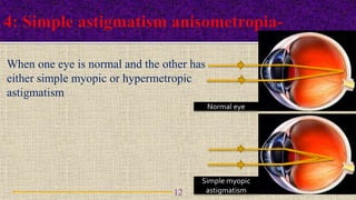 ANISOMETROPIA | PPTX
