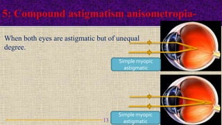 ANISOMETROPIA | PPTX