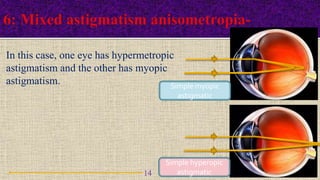 ANISOMETROPIA | PPTX