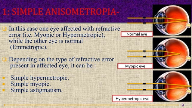 ANISOMETROPIA | PPTX | Eye and Vision Conditions | Diseases and Conditions