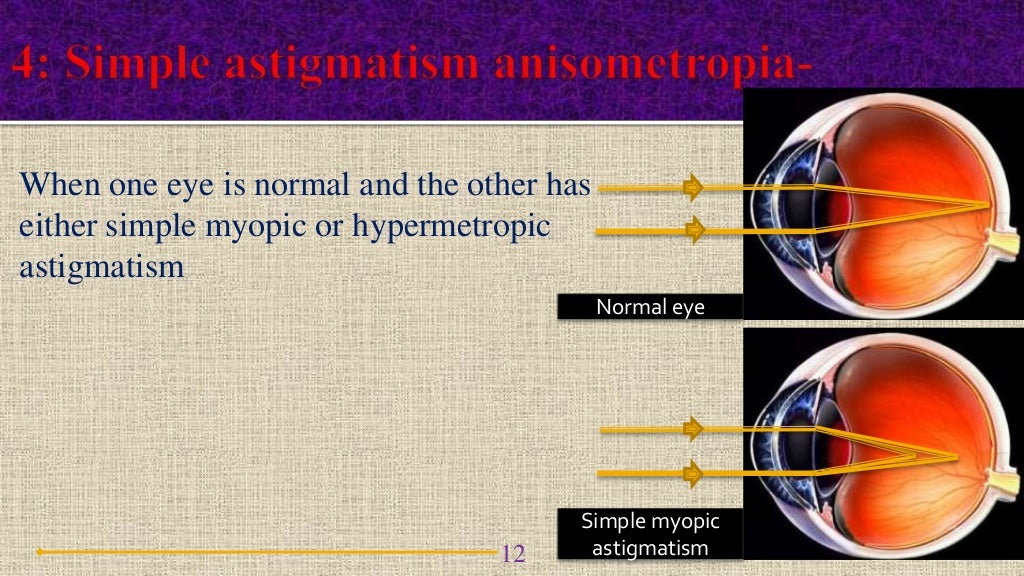 ANISOMETROPIA