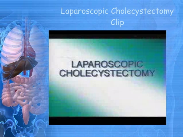 Laparoscopic Cholecystectomy | PPT