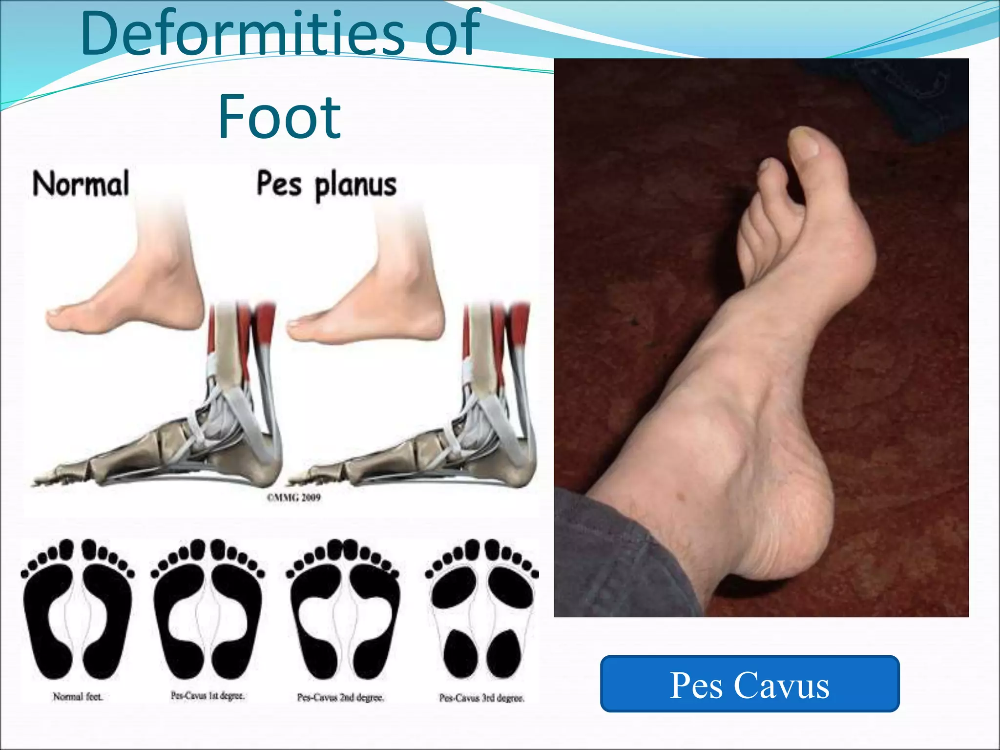 Arches of foot.ppt