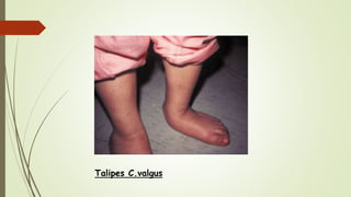 Arches of foot | PPTX