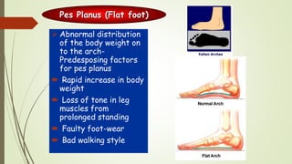 Arches of foot | PPTX