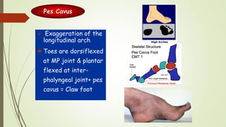 Arches of foot | PPTX