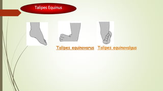 Arches of foot | PPTX