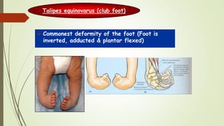 Arches of foot | PPTX