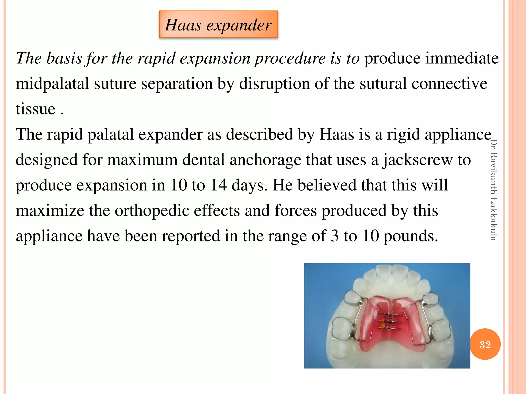 Arch expansion with fixed appliance technique | PDF
