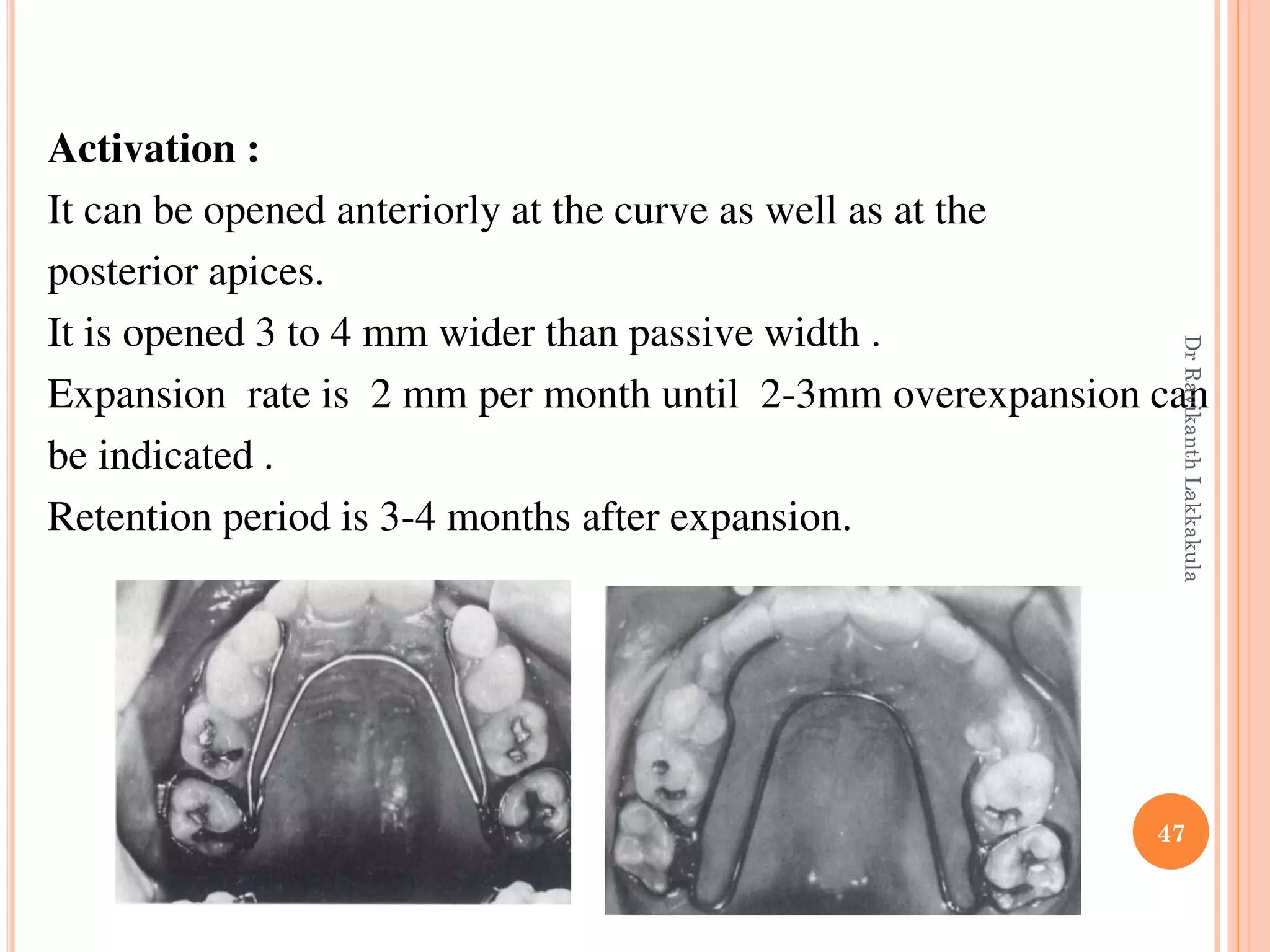 Arch expansion with fixed appliance technique | PDF