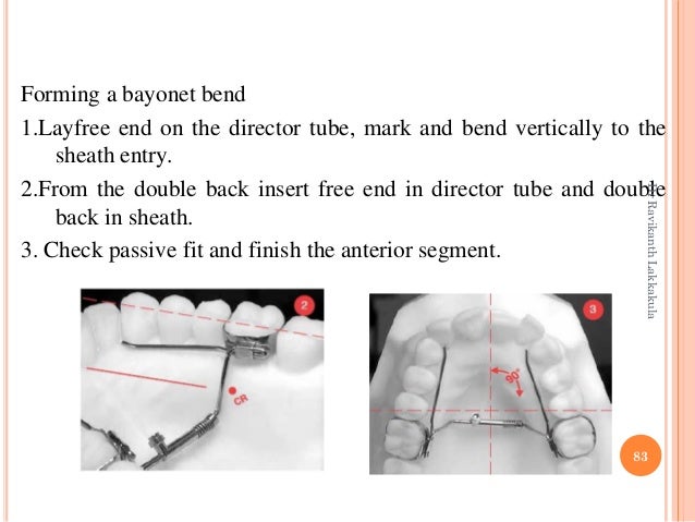 Arch expansion with fixed appliance technique