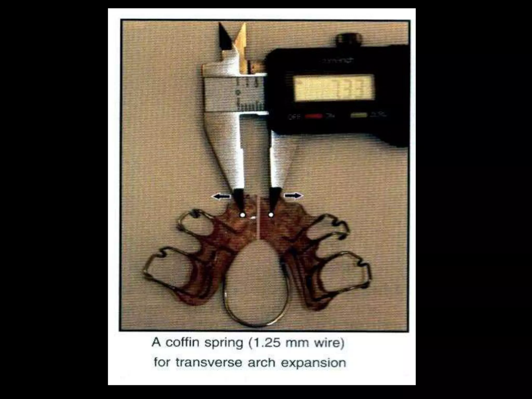 ORTHODONTIC ARCH EXPANSION | PPT