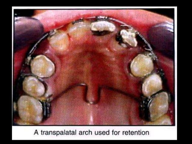 ORTHODONTIC ARCH EXPANSION | PPT
