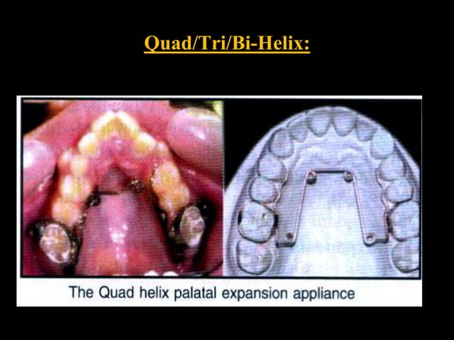 ORTHODONTIC ARCH EXPANSION | PPT
