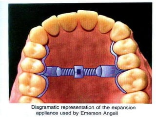 ORTHODONTIC ARCH EXPANSION | PPT