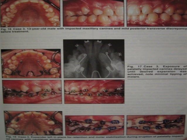 ARCH EXPANSION IN ORTHODONTICS ddd (2).ppt