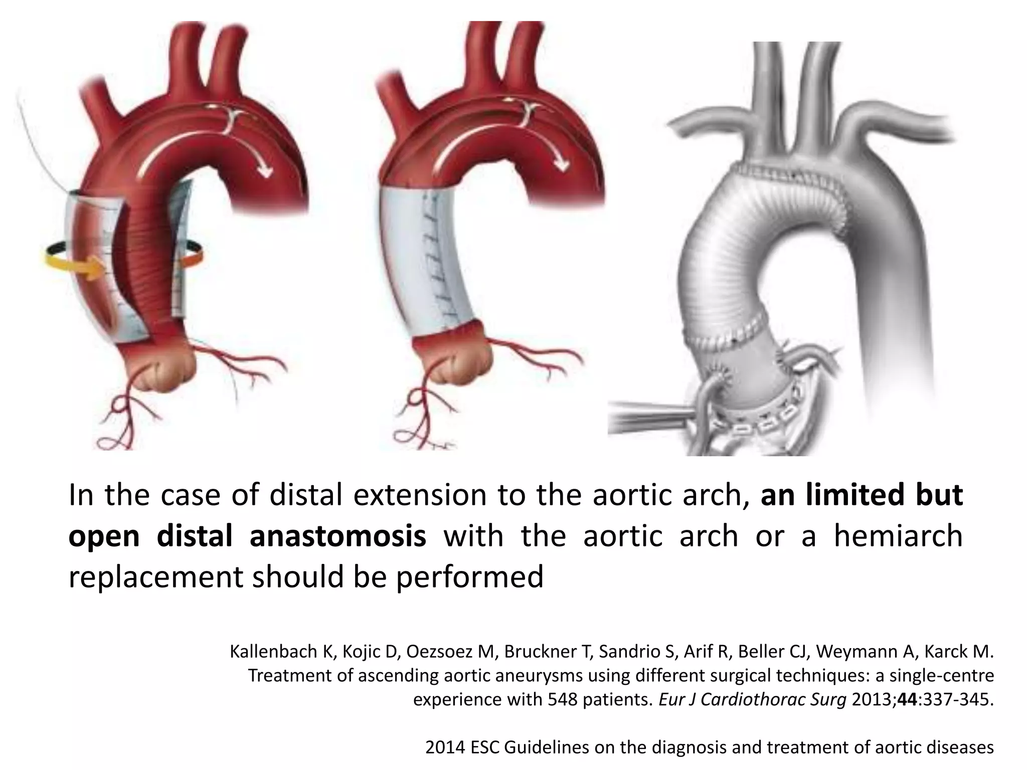 AORTIC ARCH SURGERY | PPTX