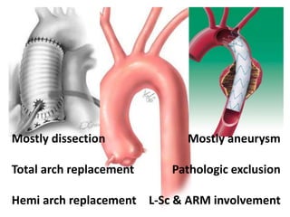 AORTIC ARCH SURGERY | PPTX