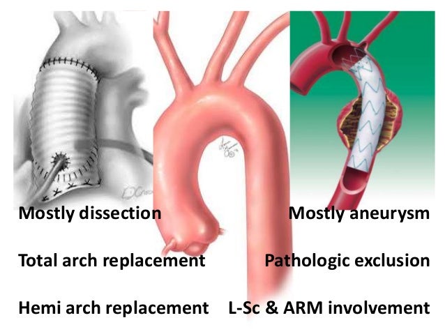 Types of aortic arch - photographygert