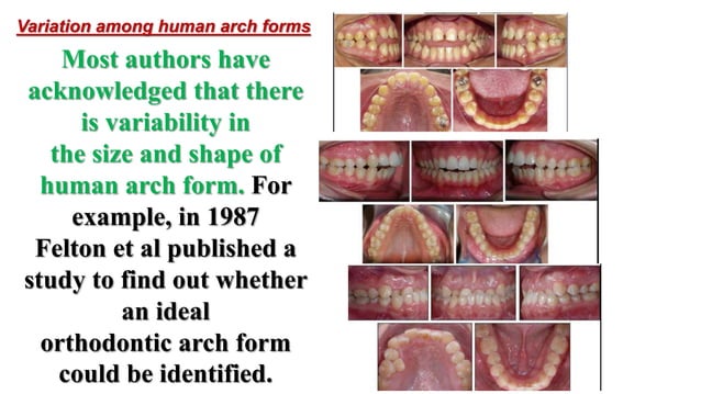 orthodontic arch form | PPTX | Dental Health | Diseases and Conditions