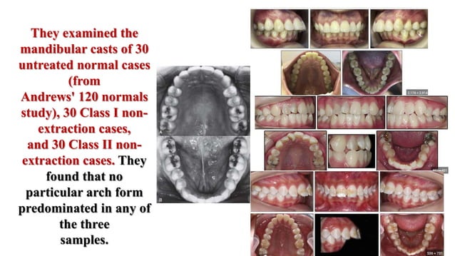 orthodontic arch form | PPTX | Dental Health | Diseases and Conditions