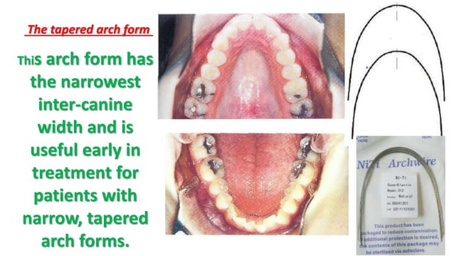 orthodontic arch form | PPTX | Dental Health | Diseases and Conditions