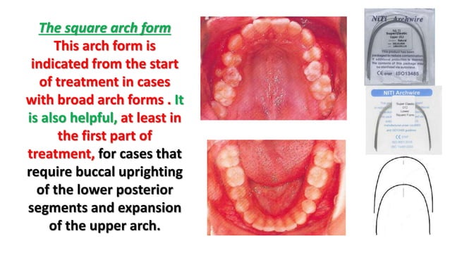orthodontic arch form | PPTX | Dental Health | Diseases and Conditions