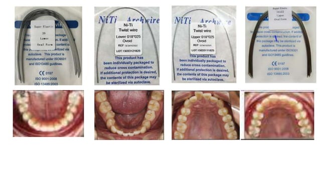 orthodontic arch form | PPTX | Dental Health | Diseases and Conditions