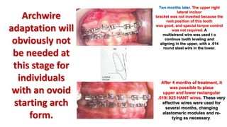 orthodontic arch form | PPTX