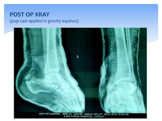Archilles tendonitis and rupture | PPT