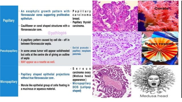 ARCHITECTURAL PATTERNS IN HISTOPATHOLOGY pdf- [Autosaved].pdf | Cancer ...