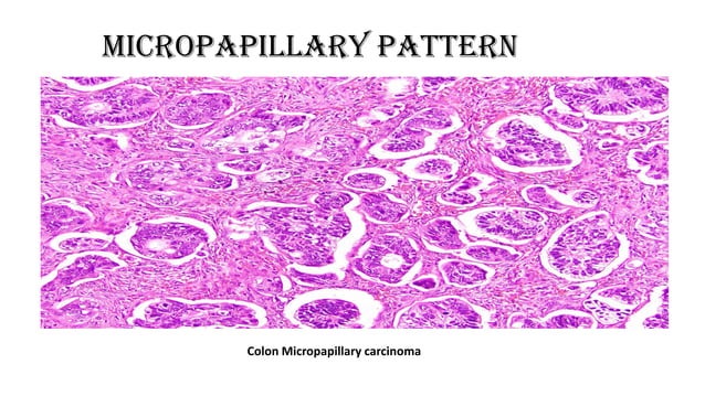 ARCHITECTURAL PATTERNS IN HISTOPATHOLOGY pdf- [Autosaved].pdf | Cancer ...