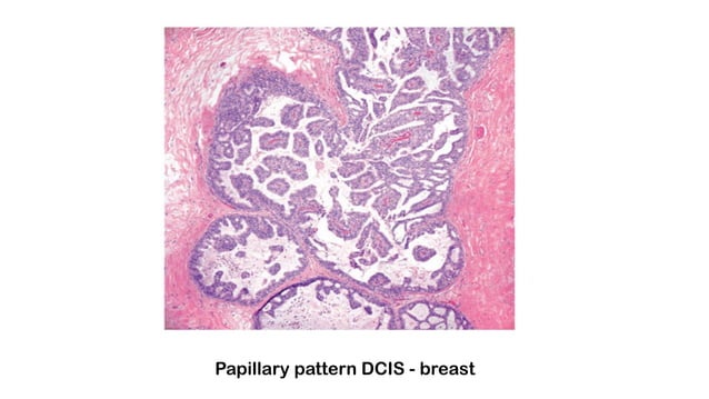 ARCHITECTURAL PATTERNS IN HISTOPATHOLOGY pdf- [Autosaved].pdf | Cancer ...