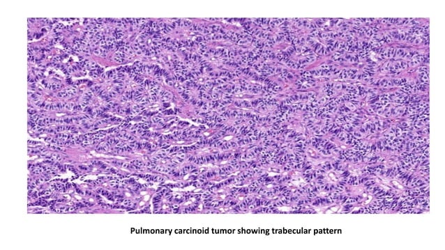 ARCHITECTURAL PATTERNS IN HISTOPATHOLOGY pdf- [Autosaved].pdf | Cancer ...
