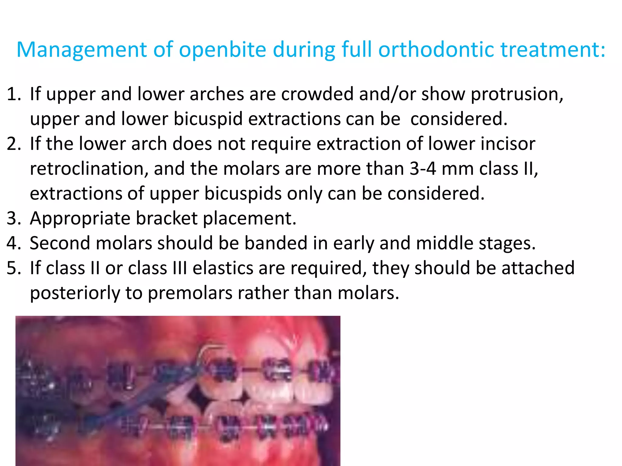 Arch leveling & overbite control | PPTX