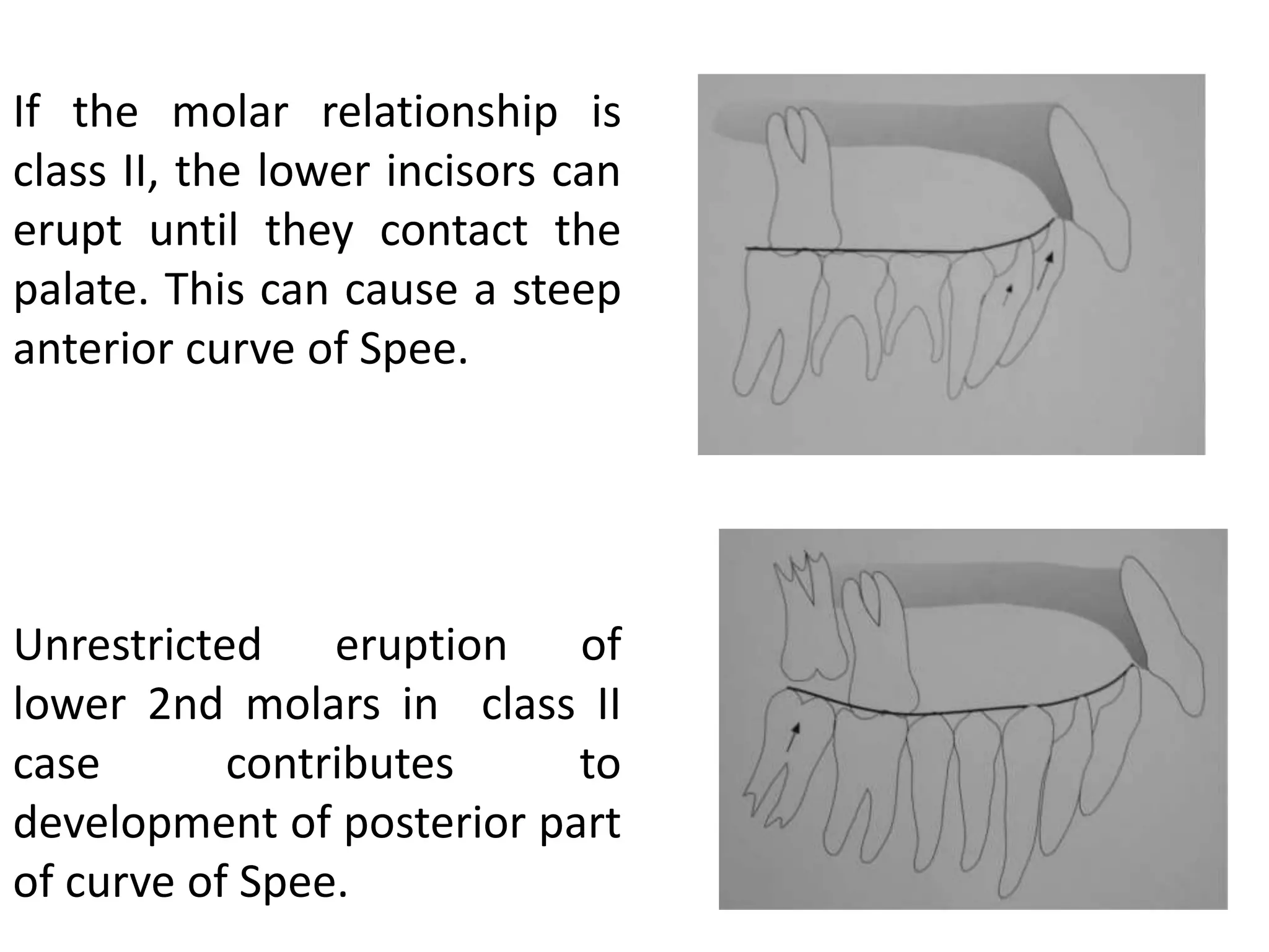 Arch leveling & overbite control | PPTX