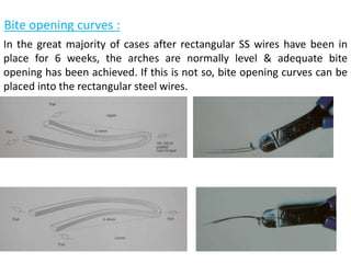 Arch leveling & overbite control | PPTX | Dental Health | Diseases and ...