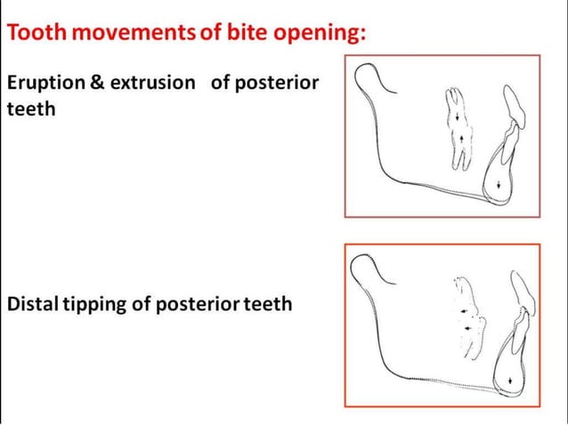 Arch leveling & overbite control | PPTX | Dental Health | Diseases and ...