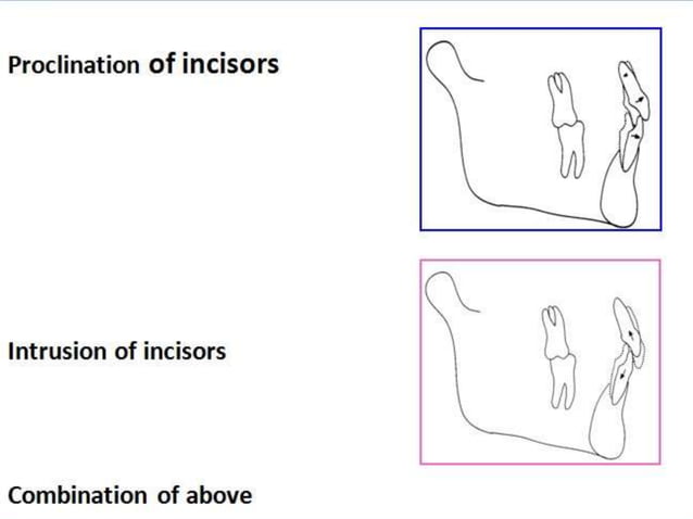 Arch leveling & overbite control | PPTX | Dental Health | Diseases and ...